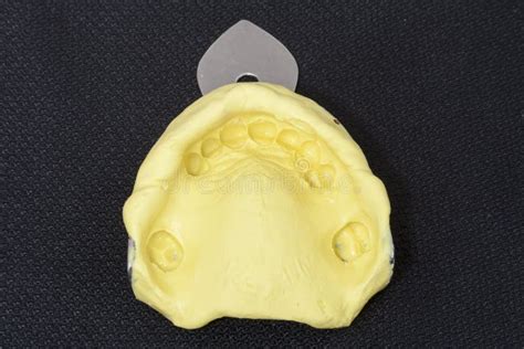 Oral Rehabilitation Process Partial Removable Prosthesis Stock Image