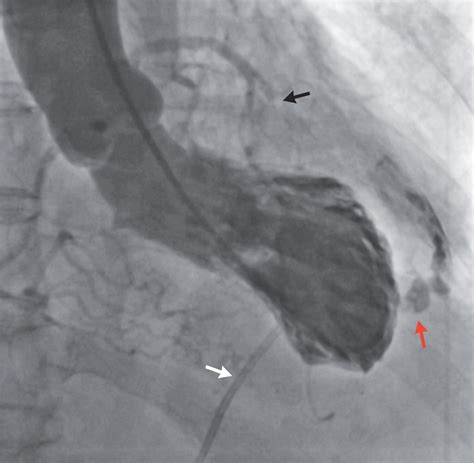 Left Ventricular Rupture New England Journal Of Medicine