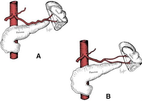 Splenic Artery Diagram