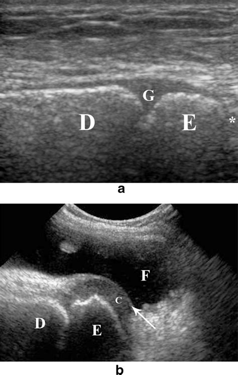 Sonographic Appearance Of The Developing Bone A Longitudinal