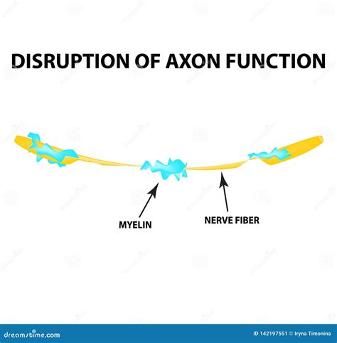 The Destruction Of The Myelin Sheath On The Axon Damaged Myelin