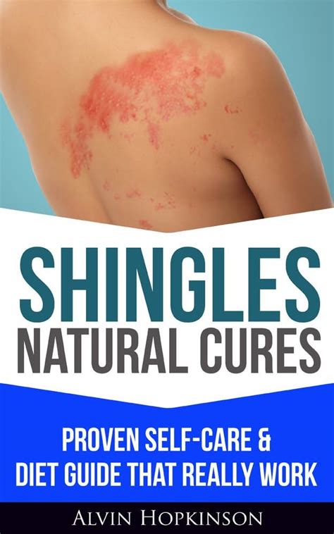 Home Remedies For Shingles Thriftyfun Home Remedies For Shingles