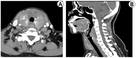 A Case Of Diffuse Thyroid Hematoma After Ultrasound Guided Fine Needle