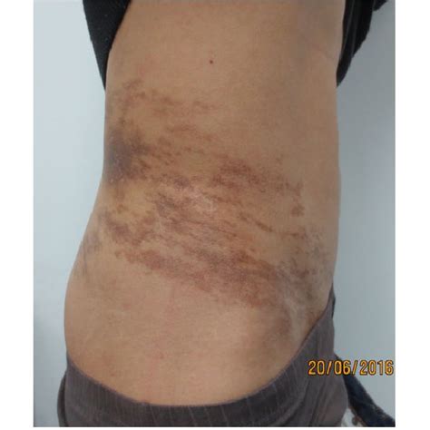 Case One Hyperpigmented Macules And Patches In A Blaschkoid