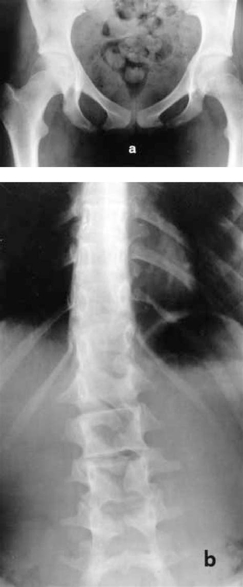 Figure 3 From Ischiopubic Hypoplasia A Rare Constituent Of Congenital