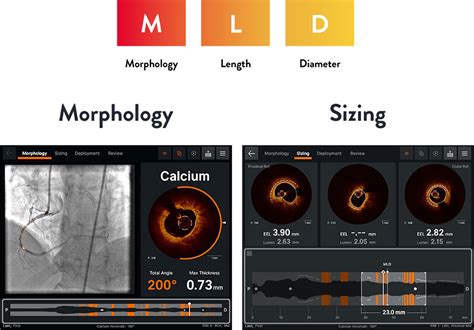 Ultreon™ 1 0 Software For Oct Intravascular Imaging Abbott