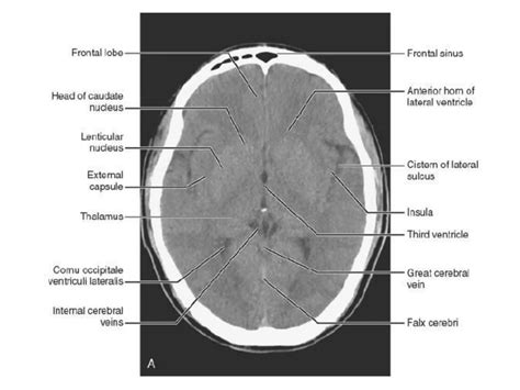 Ct And Mri Anatomy Of Brain Pdf
