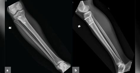 Open Tib Fib Fracture