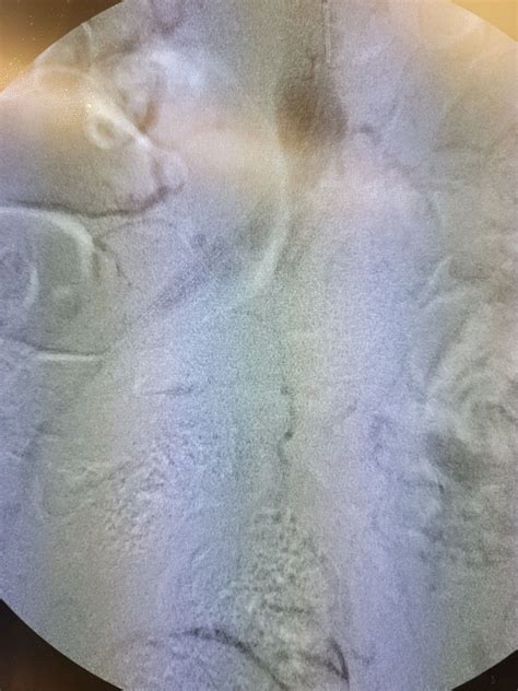 Daniel M Alterman Md Facs Fsvs Rpvi On Linkedin Inflow Restoration Can Be Transformative