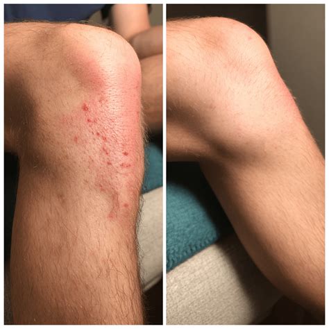 Suprapatellar Joint Effusion Understanding Knee Swelling And Effective Management