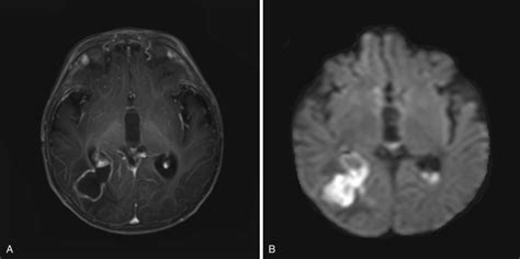 Cerebral Infections And Inflammation Radiology Key