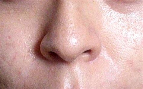 Cildin Yağlanması Kozanbilginet