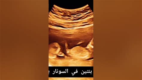 ولدين و لا بنتين في السونار بنظريه ناب 🤔؟؟؟ Youtube
