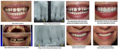 Lateral Incisor Before Central Incisor