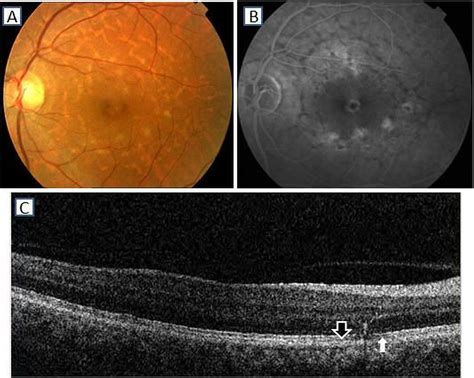 Common Spectral Domain Oct And Electrophysiological Findings In