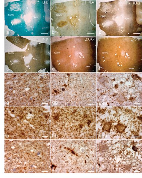 Figure 1 From Mitochondrial Defects In Acute Multiple Sclerosis Lesions