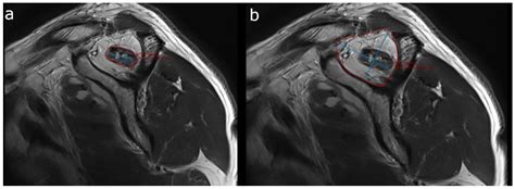 Three Dimensional Software And Mr Imaging Based Muscle Volumetry