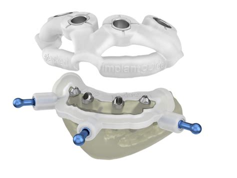 Digital Dental Implant Planning Software Patient Communication Tools