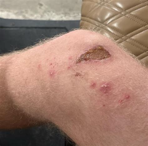 Staph Or Something Else Rstaphacne