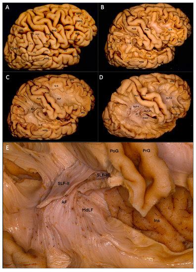 Supramarginal Gyrus And Angular Gyrus Subcortical Connections A