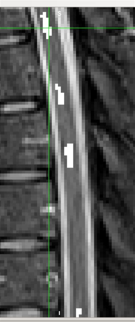 SCT V Incorrect Lesion Detection SCT Spinalcordmri Org
