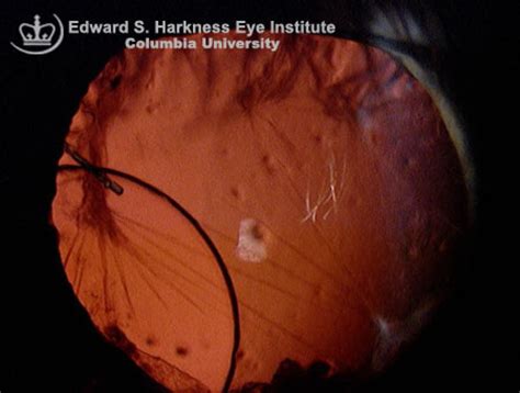 Sunset Syndrome Vagelos College Of Physicians And Surgeons