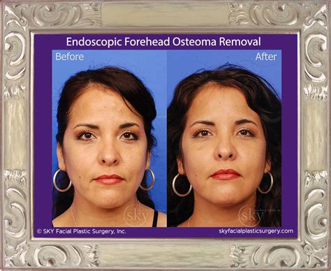 Osteoma Forehead