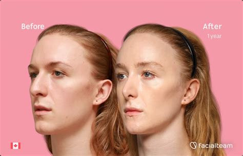 Isla Before And After Ffs Surgery — Facialteam