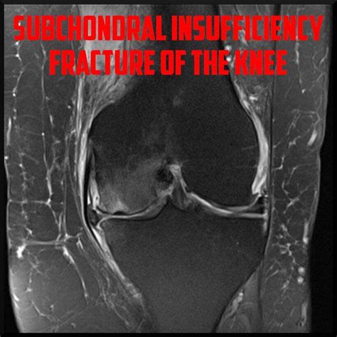 Subchondral Insufficiency Fracture Of The Knee Sports Medicine Review