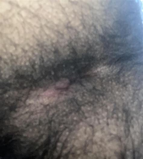 Does This Look Like Haemorrhoids Rhemorrhoid