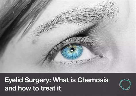 Eyelid Surgery What Is Chemosis And How To Treat It Pdf