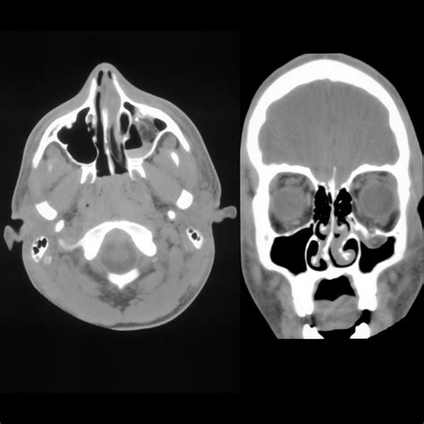 Pediatric Orbital Blowout Fracture Pediatric Radiology Reference